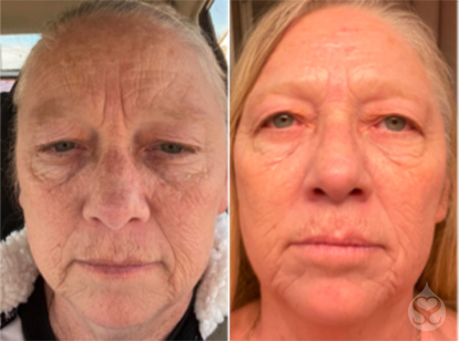 RF Microneedling - Skin Solutions Dermatology