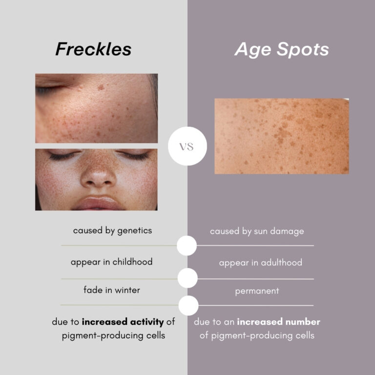 Freckles vs. Age Spots: Can You Tell the Difference? - Skin Solutions ...