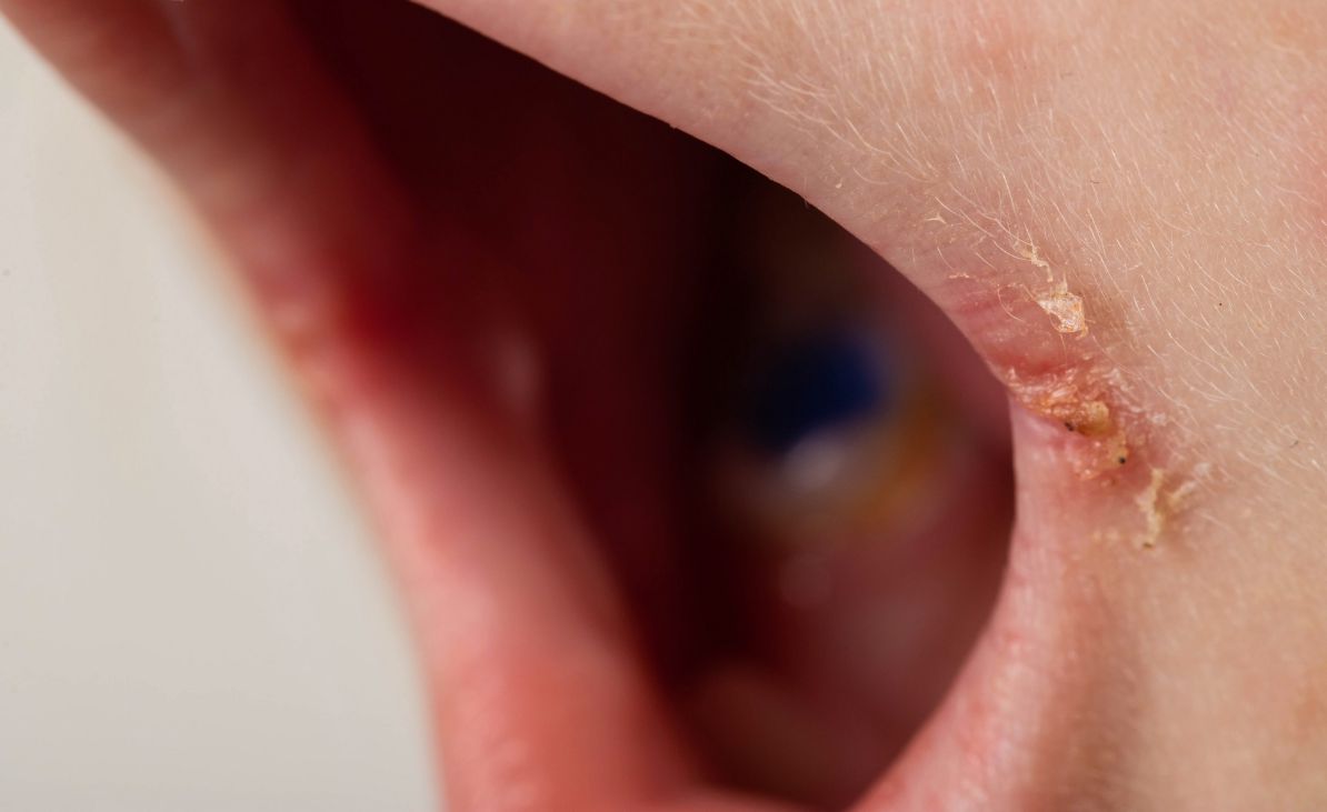 Angular Cheilitis: What You Need to Know - Skin Solutions Dermatology