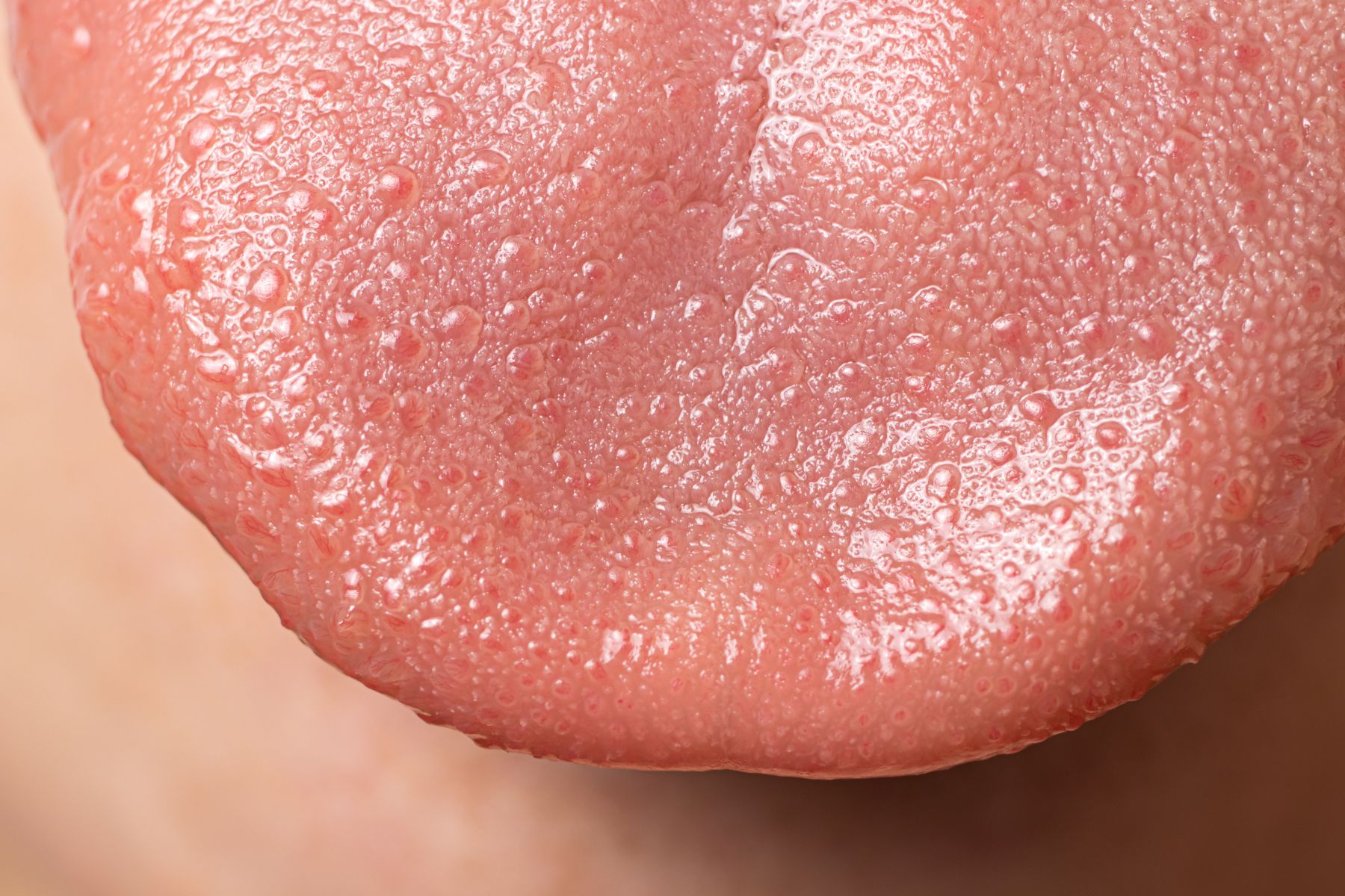 Hairy Tongue: What You Need to Know - Skin Solutions Dermatology